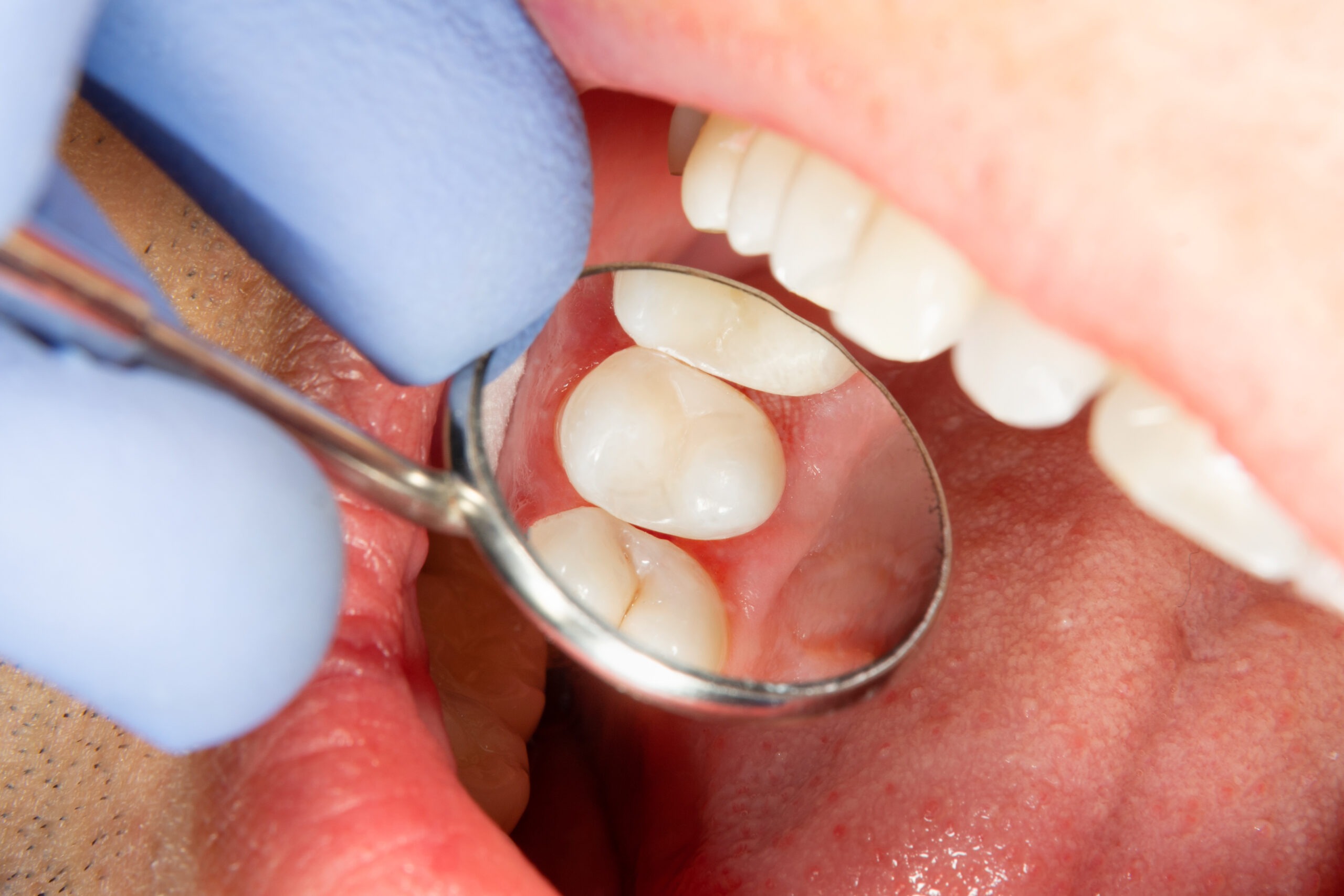 Fissure Sealants Quedgeley | Dental Sealants Gloucester