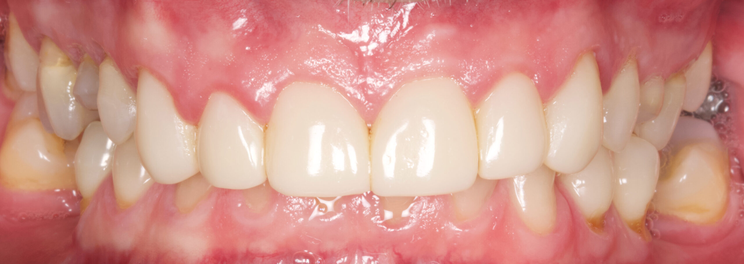 Smile Gallery Quedgeley | Tooth Wear | Orthodontics Gloucester