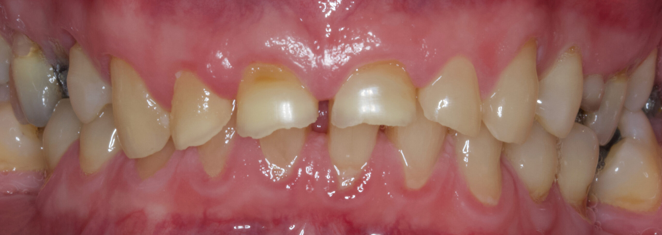 Smile Gallery Quedgeley | Tooth Wear | Orthodontics Gloucester