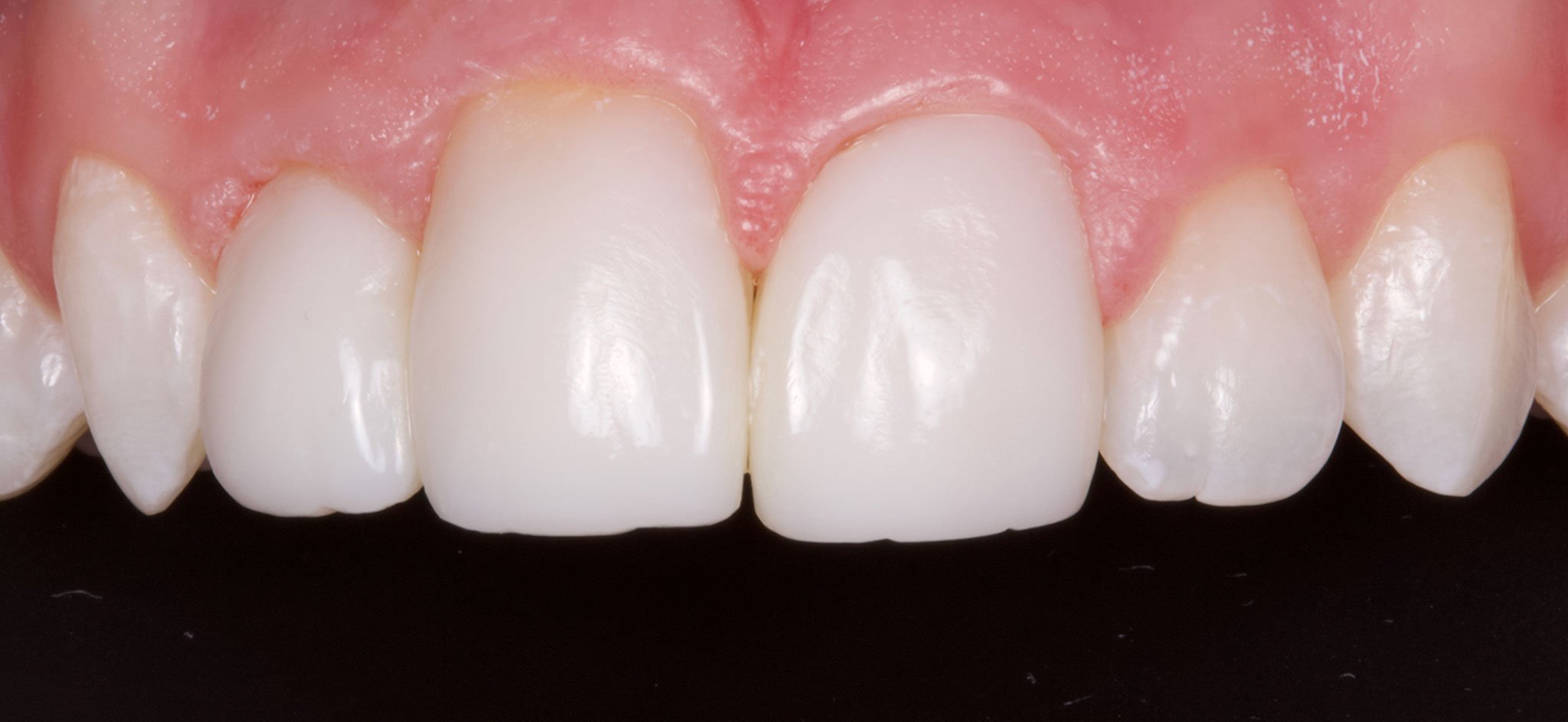 Smile Gallery Quedgeley | Veneers | Dentist Gloucester