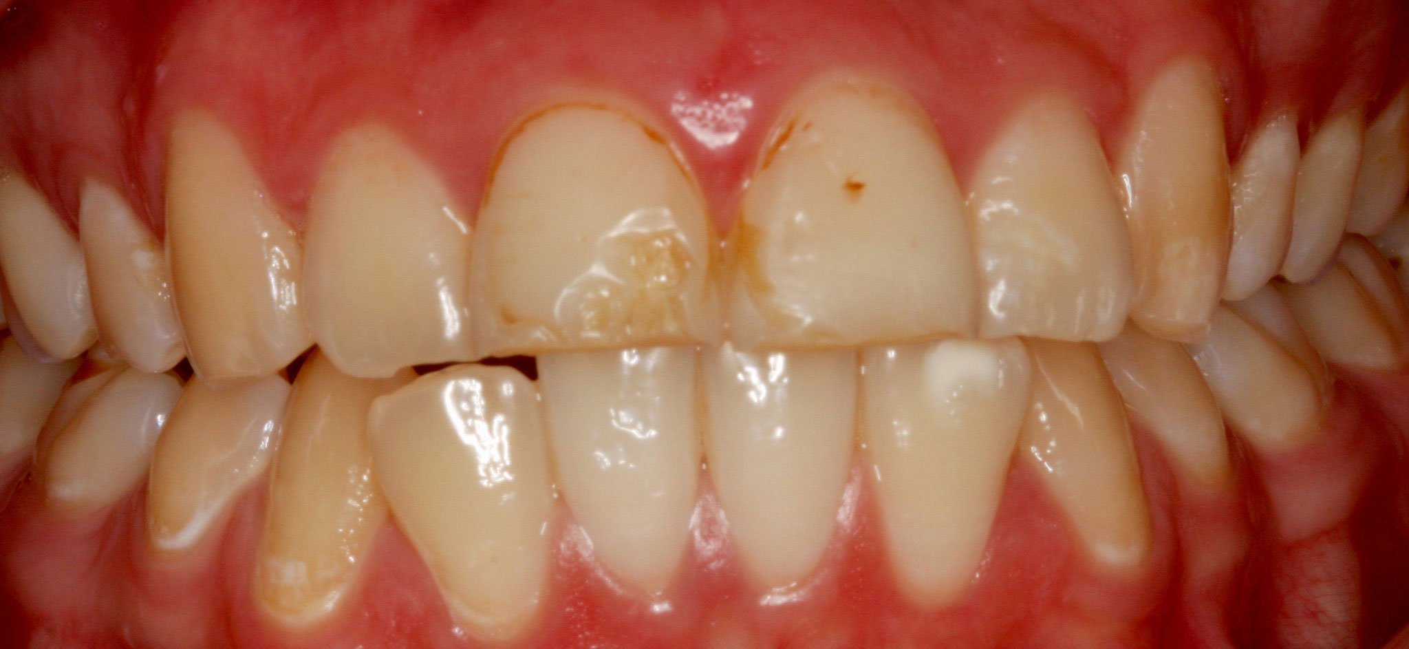 Smile Gallery Quedgeley | Veneers | Dentist Gloucester
