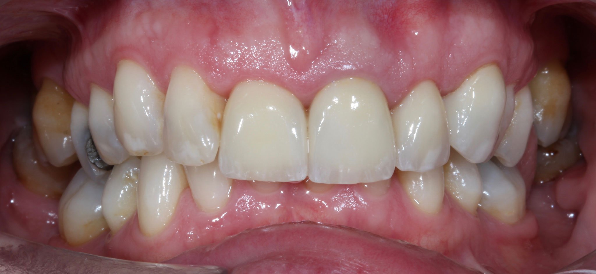 Smile Gallery Quedgeley | Veneers | Dentist Gloucester