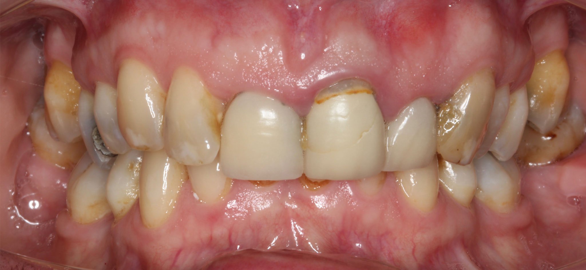 Smile Gallery Quedgeley | Veneers | Dentist Gloucester