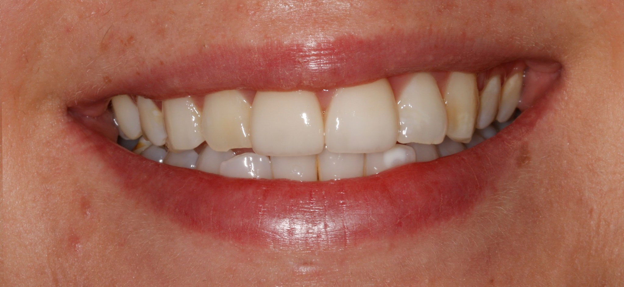 Smile Gallery Quedgeley | Veneers | Dentist Gloucester